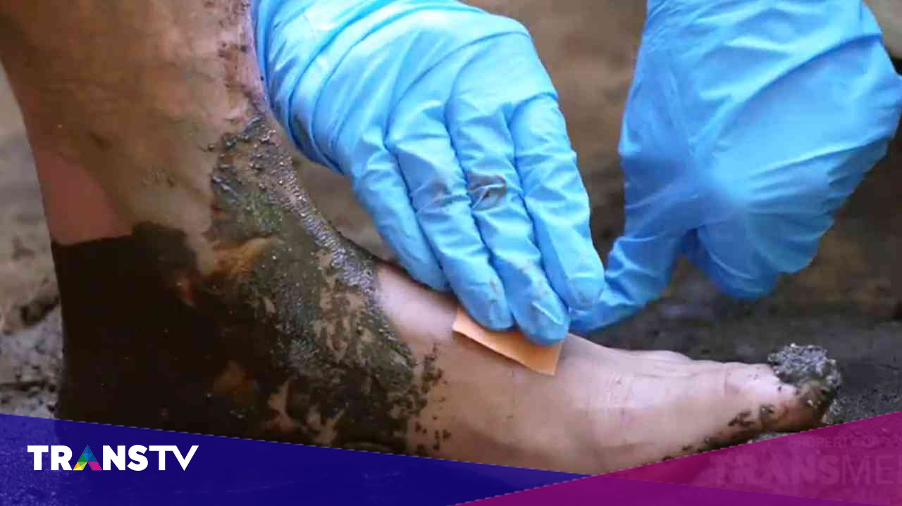 Digigit Lintah? Tak Usah Panik, Lakukan Pertolongan Pertama Ini! - Trans TV